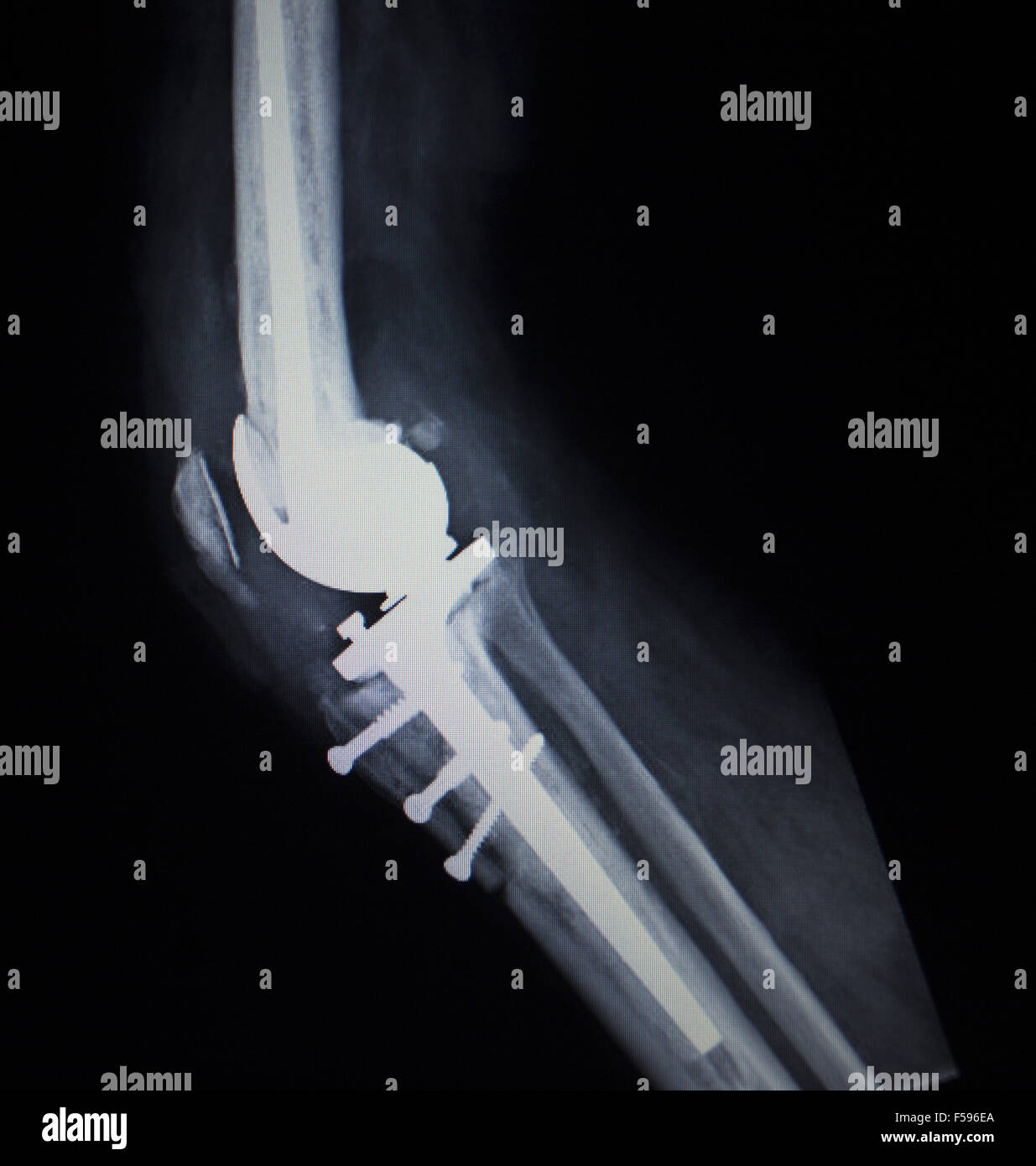 X-ray orthopedic medical CAT scan of painful knee meniscus injury leg ...