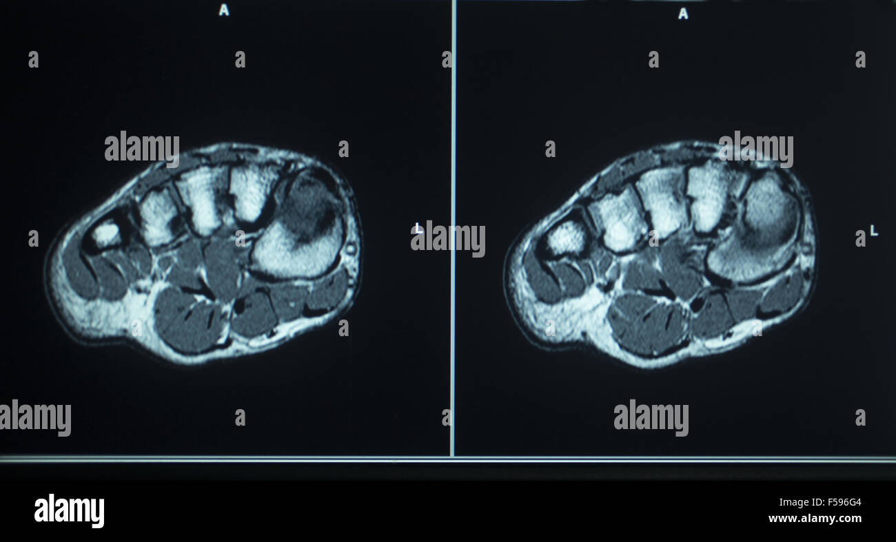 MRI magentic resonance imaging nuclear scanning scan test results foot ...
