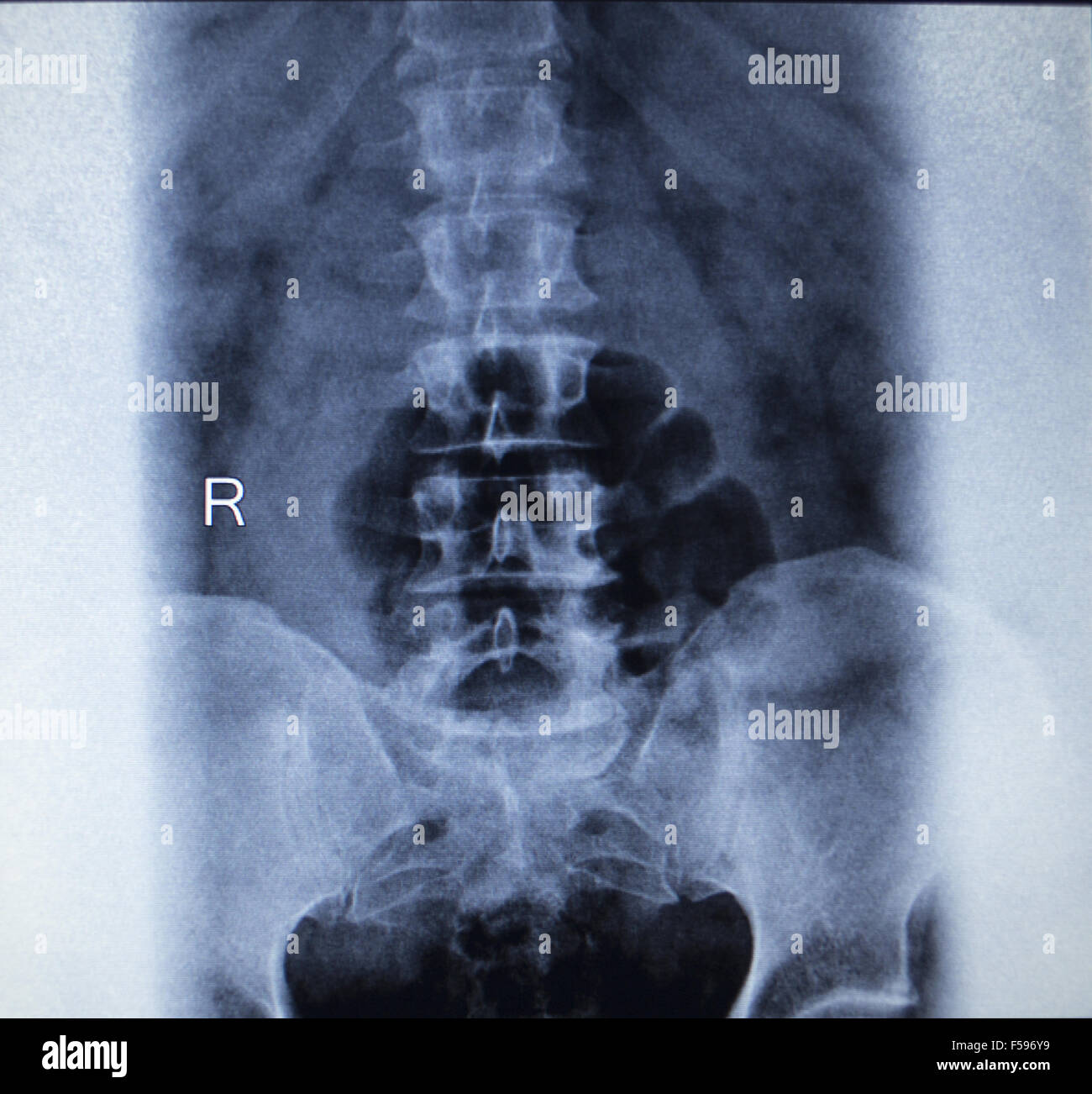 X Ray Lower Back Stock Photos & X Ray Lower Back Stock Images - Alamy