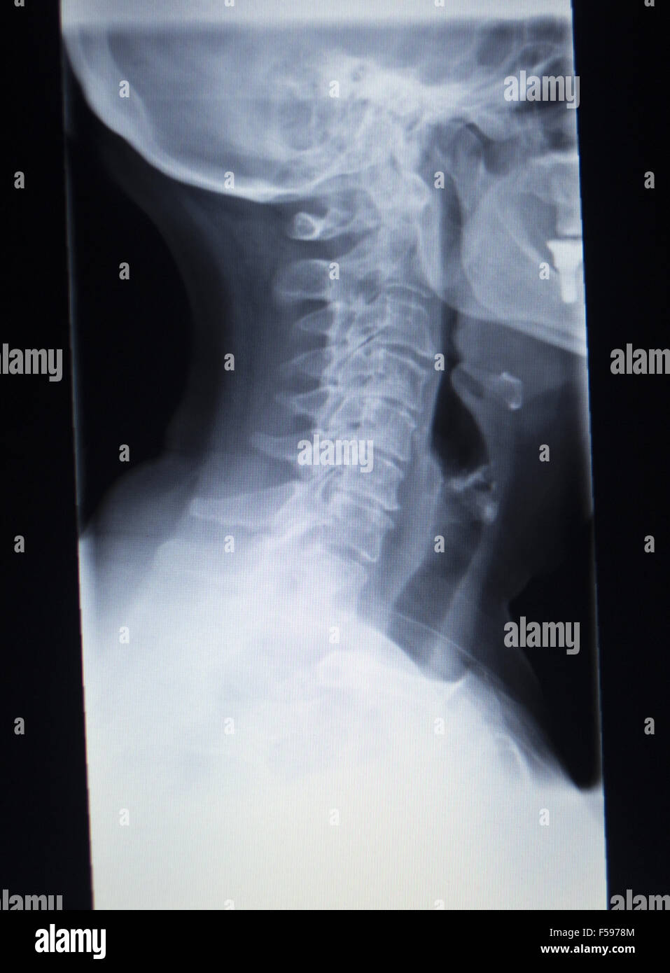 X-ray orthopedic medical CAT scan of painful neck injury in ...