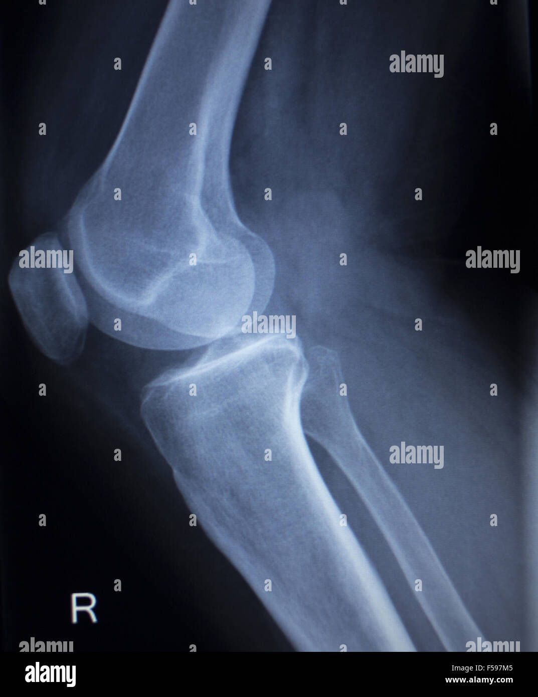 X-ray orthopedic medical CAT scan of painful knee meniscus injury leg ...
