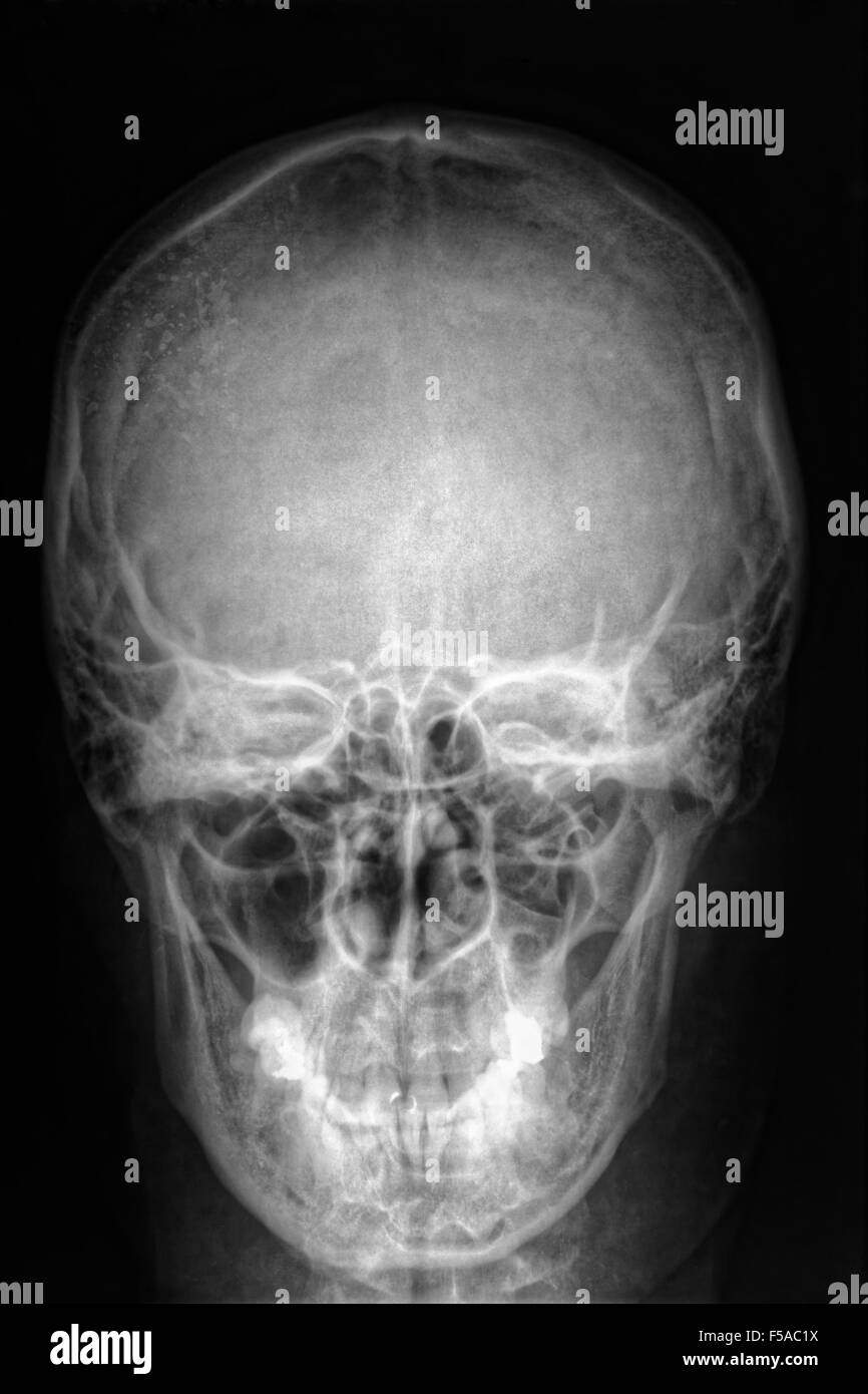 film x-ray skull of human, Medical,Science and Healthcare concept ...