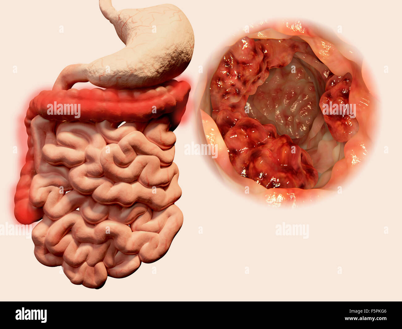 Colon cancer. Computer illustration of a cancerous (malignant) tumour ...