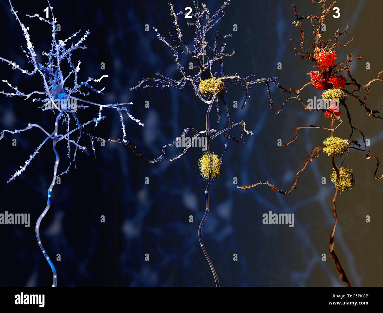 Alzheimer's disease. Computer illustration of a healthy neuron (left ...
