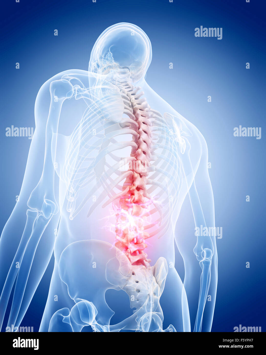 medically accurate illustration of a painful back Stock Photo - Alamy