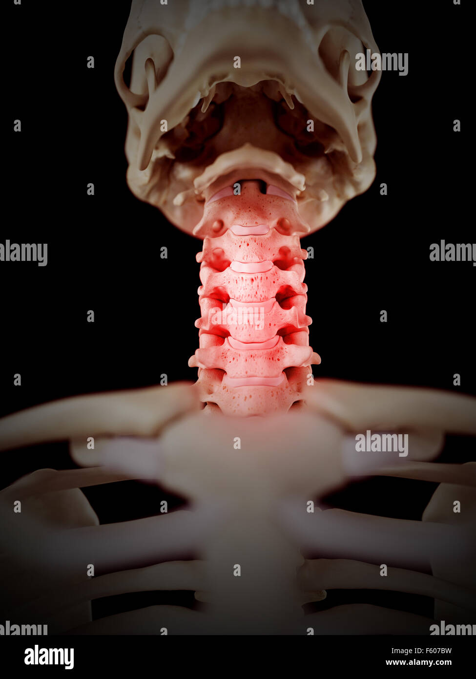 medically accurate illustration - painful spine Stock Photo - Alamy