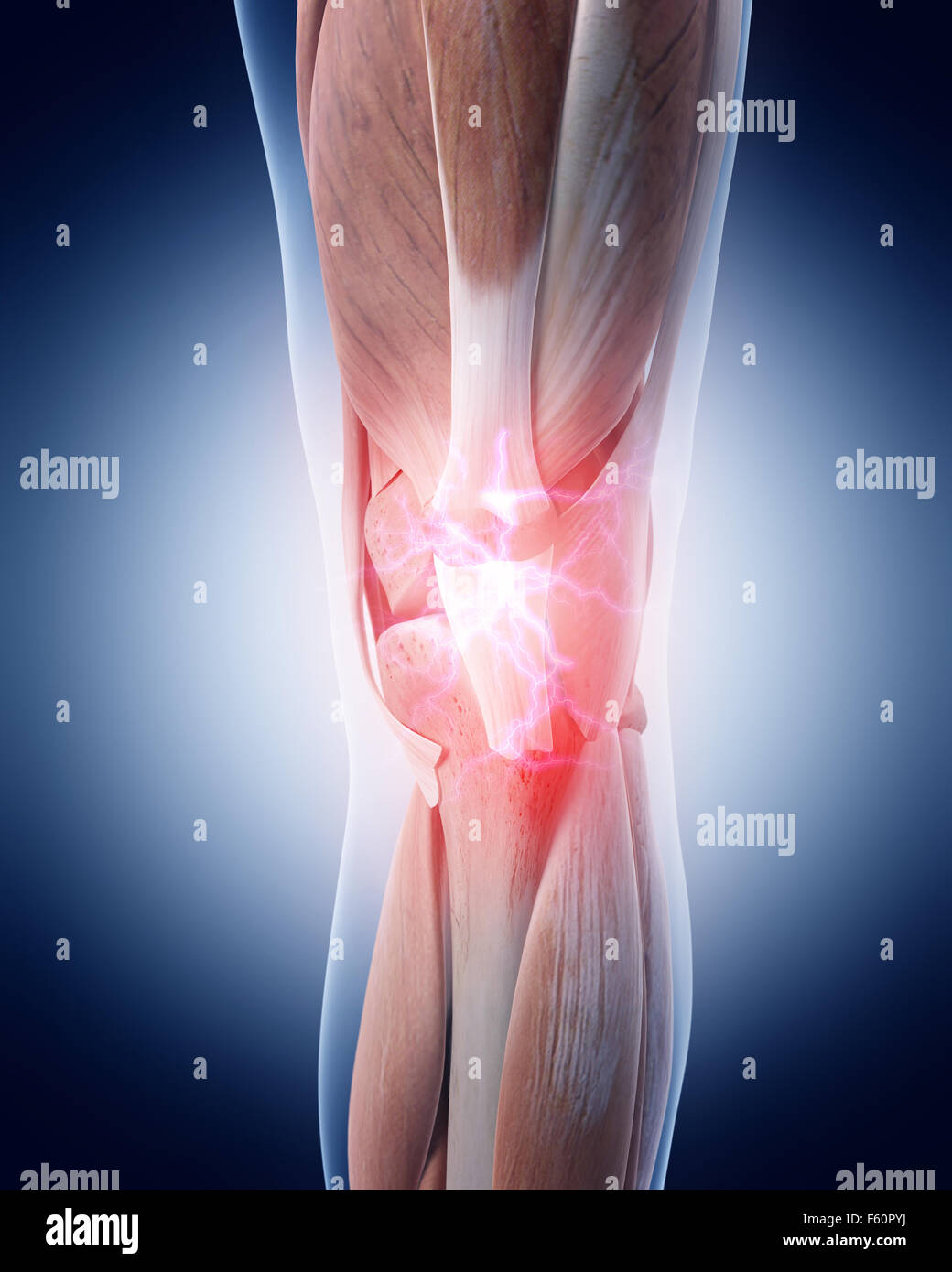 Inflamed tendon hi-res stock photography and images - Alamy