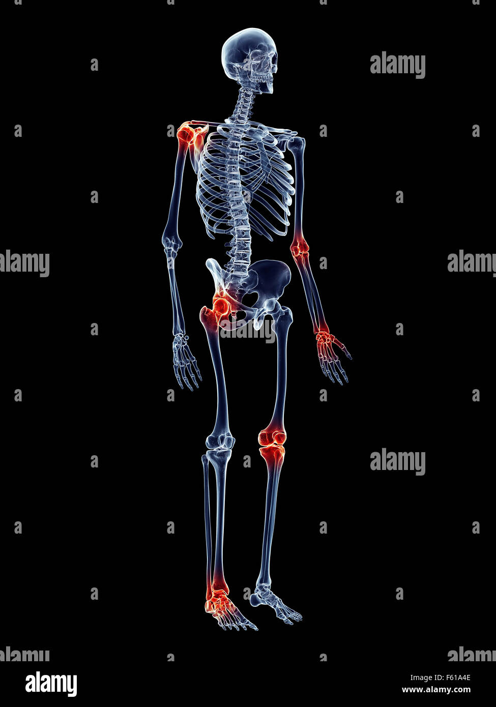 medically accurate illustration - painful joints Stock Photo - Alamy