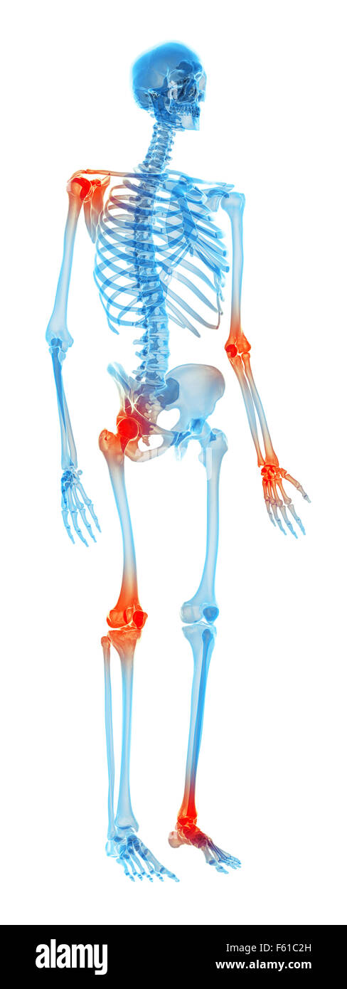 Illness joints Cut Out Stock Images & Pictures - Alamy