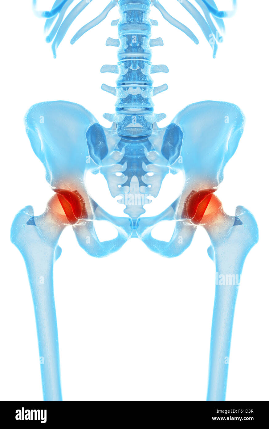 medically accurate illustration - painful hip Stock Photo - Alamy