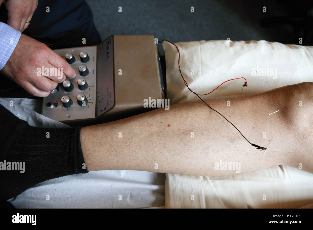 Electro acupuncture being applied with needles to patients leg Stock ...