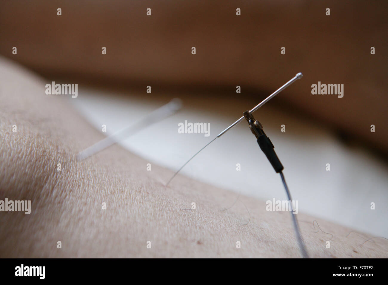 Electro acupuncture being applied with needles to patients leg Stock ...