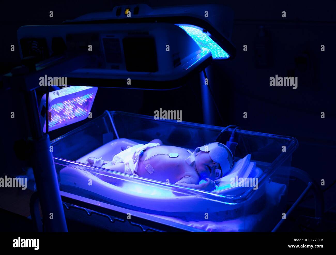 A premature baby is treated with ultra-violet light in a hospital ...
