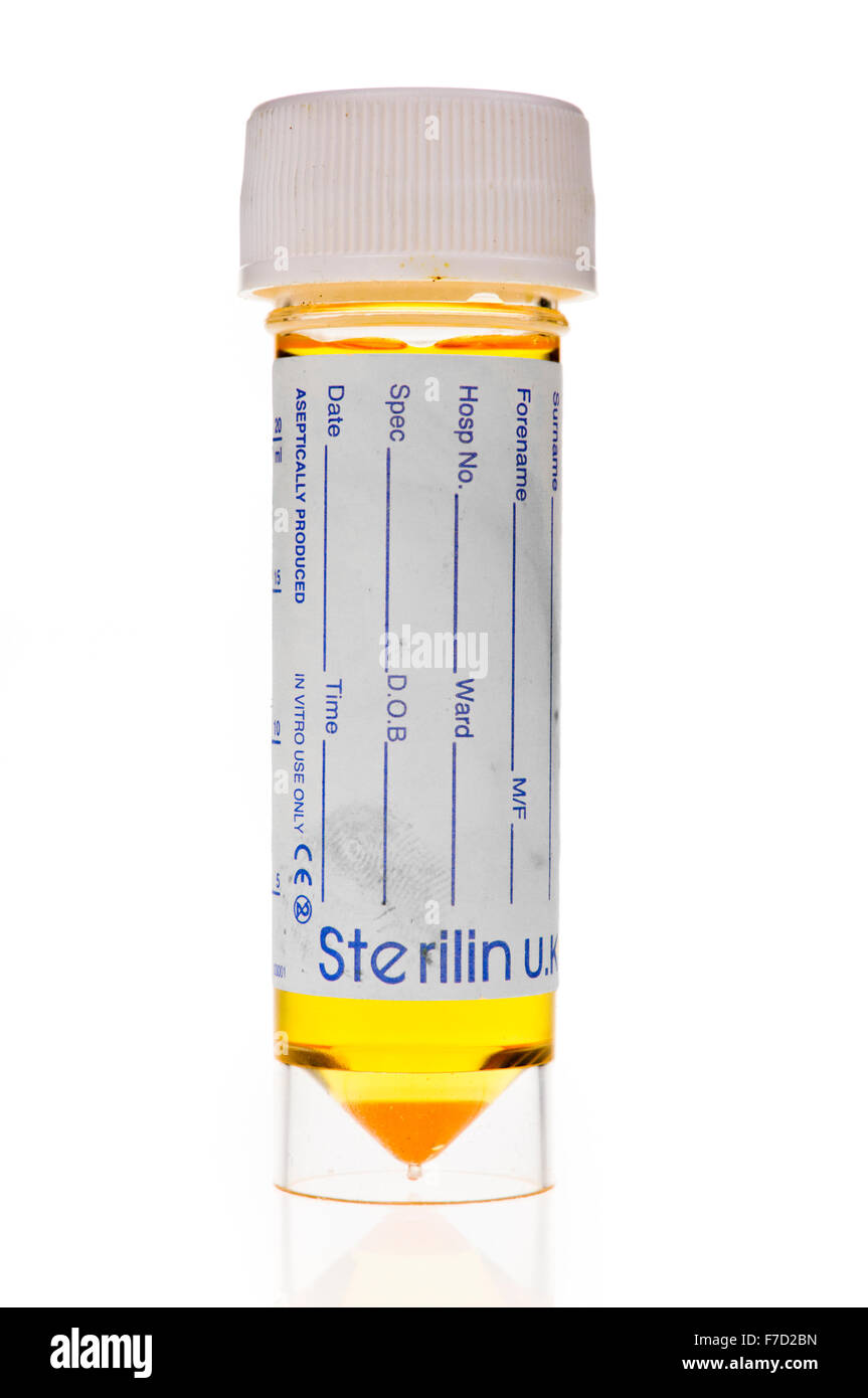 Urine sample in a clear, plastic sample bottle Stock Photo - Alamy