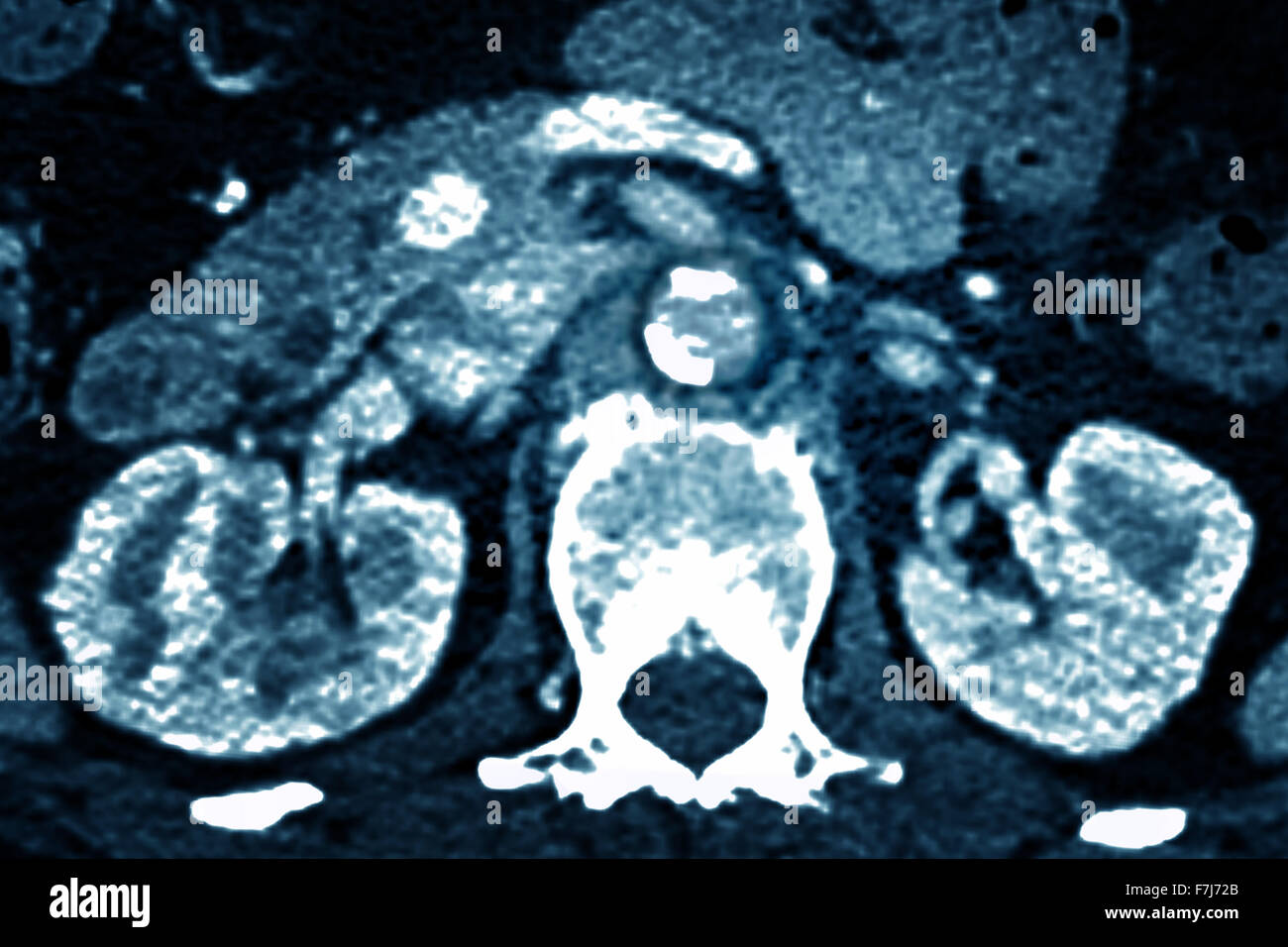 ARTERIAL CALCIFICATION CT SCAN Stock Photo - Alamy