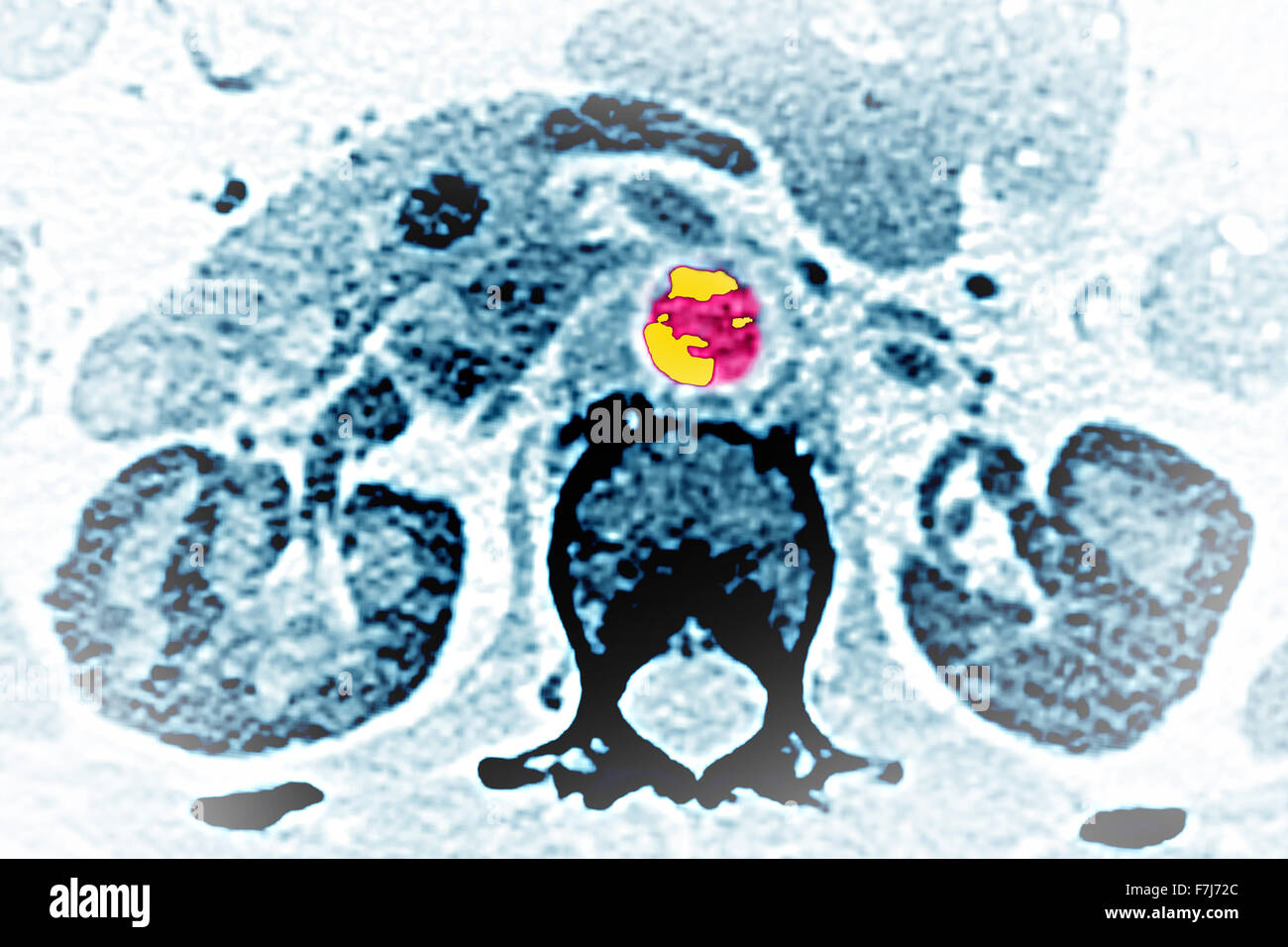 ARTERIAL CALCIFICATION CT SCAN Stock Photo - Alamy