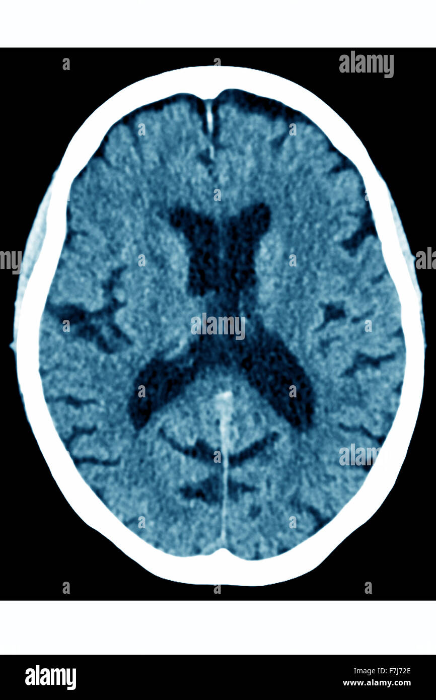 CEREBRAL ATROPHY, CT SCAN Stock Photo - Alamy