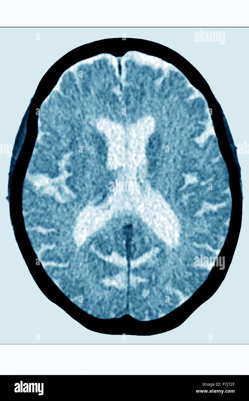 CEREBRAL ATROPHY, CT SCAN Stock Photo - Alamy
