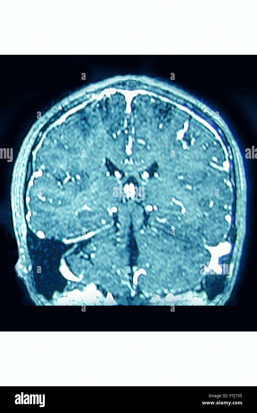 HEMORRHAGE, BRAIN MRI Stock Photo - Alamy