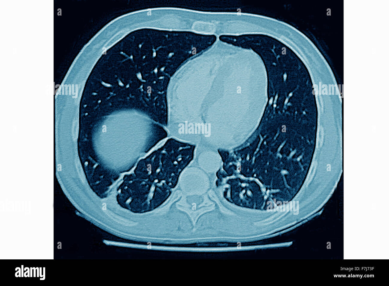 PULMONARY INFARCTION CT SCAN Stock Photo - Alamy