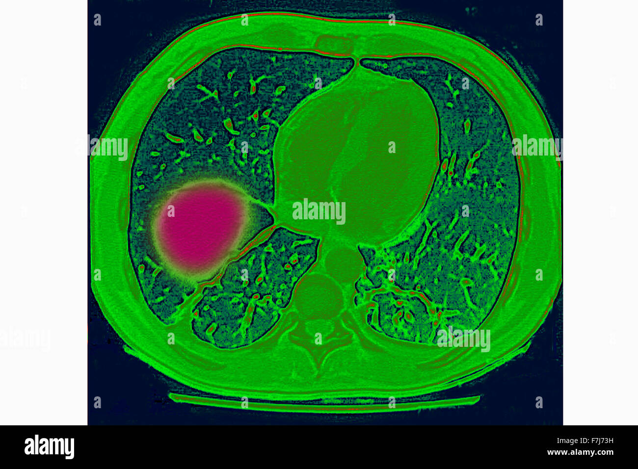 PULMONARY INFARCTION CT SCAN Stock Photo - Alamy