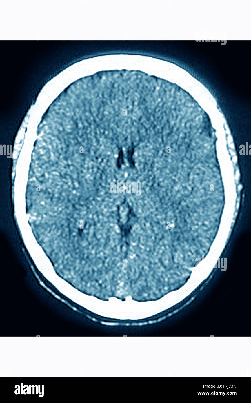 BRAIN EDEMA CT SCAN Stock Photo - Alamy BRAIN EDEMA CT SCAN Stock Photo - Alamy