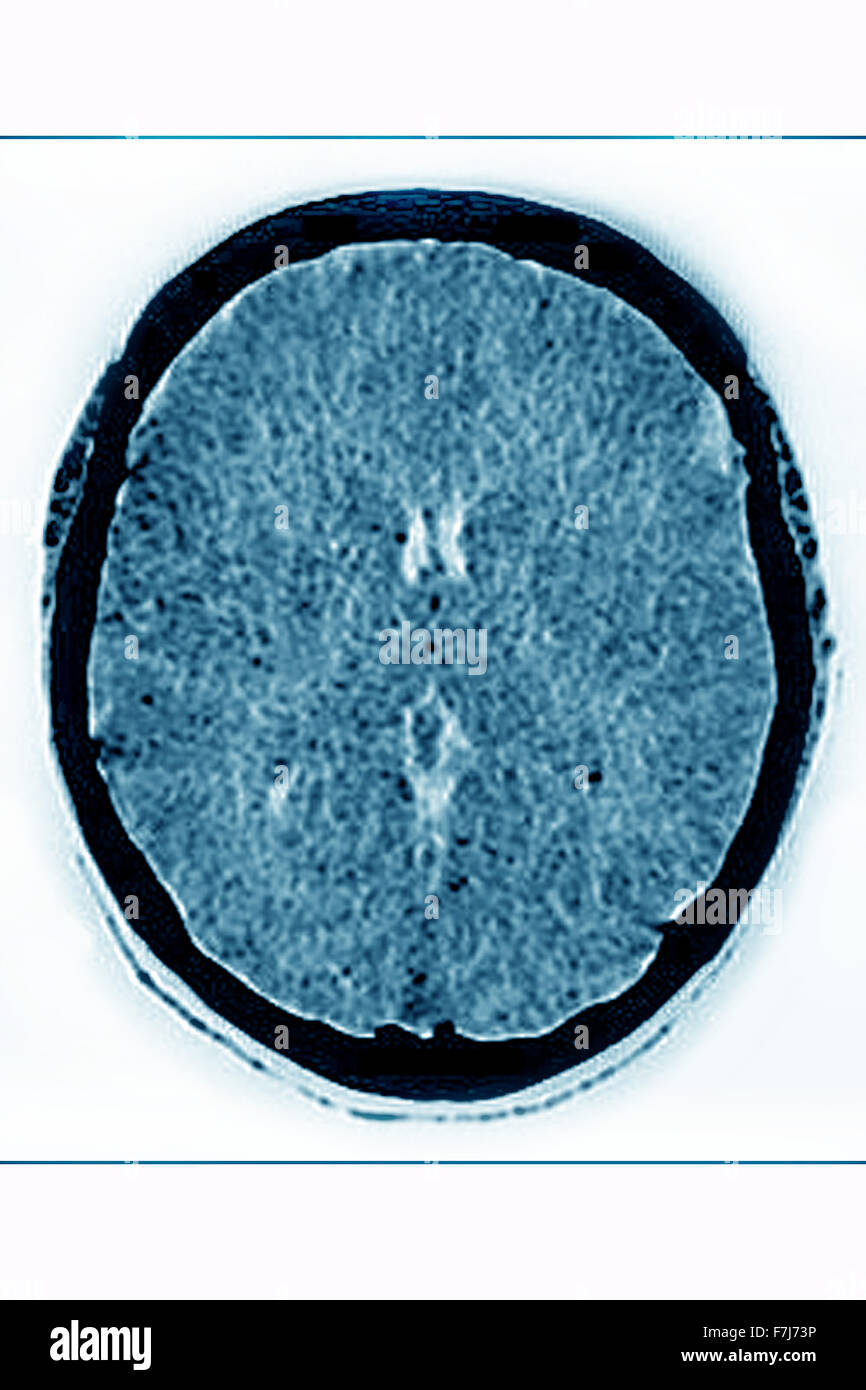 BRAIN EDEMA CT SCAN Stock Photo - Alamy