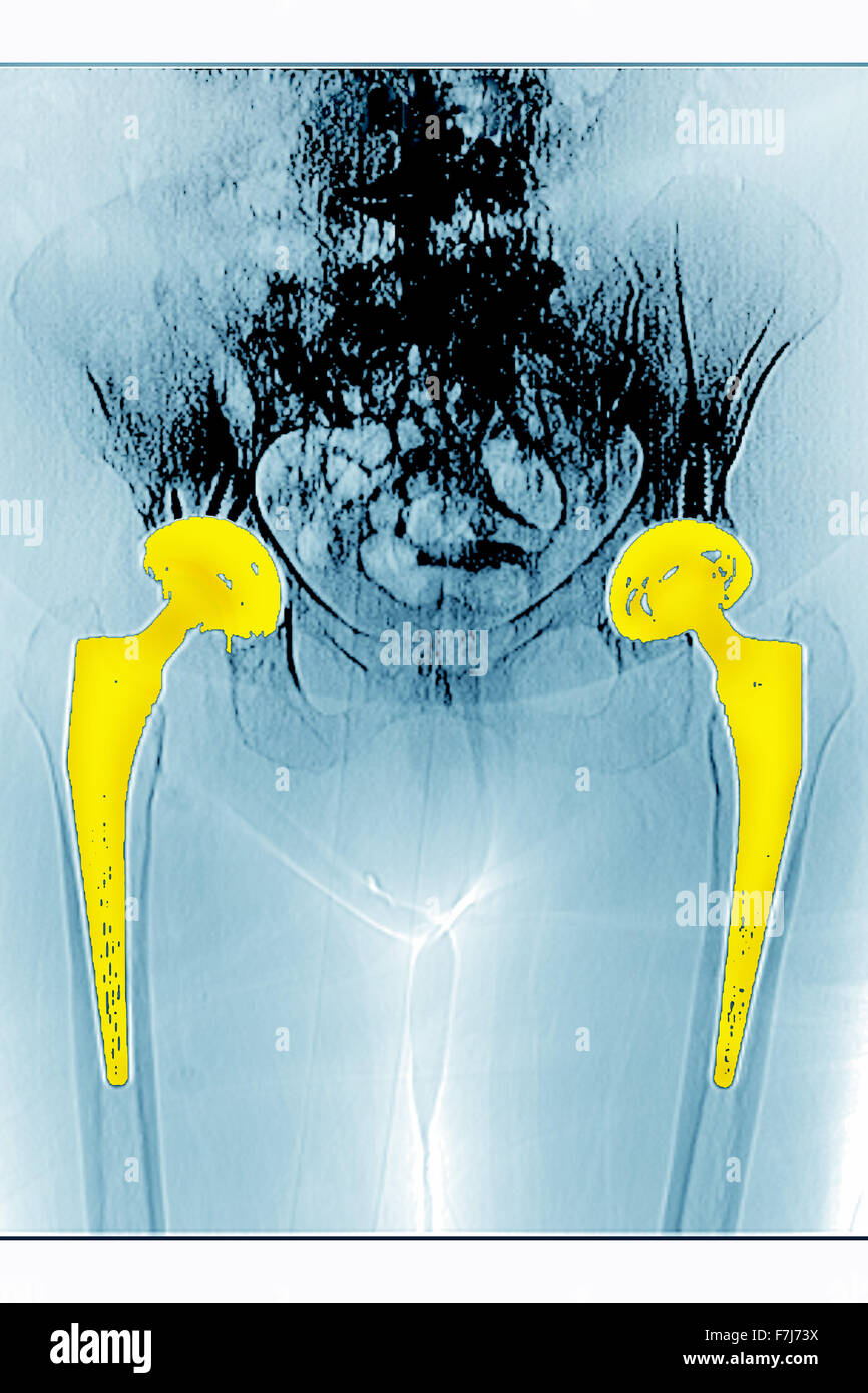 Hip replacement x ray hi-res stock photography and images - Alamy