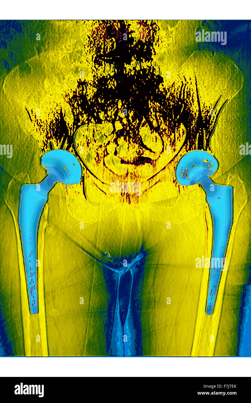 HIP PROSTHESIS, X-RAY Stock Photo - Alamy