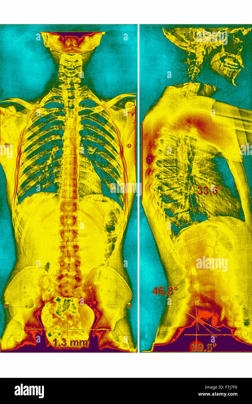 SPINAL COLUMN, X-RAY Stock Photo - Alamy