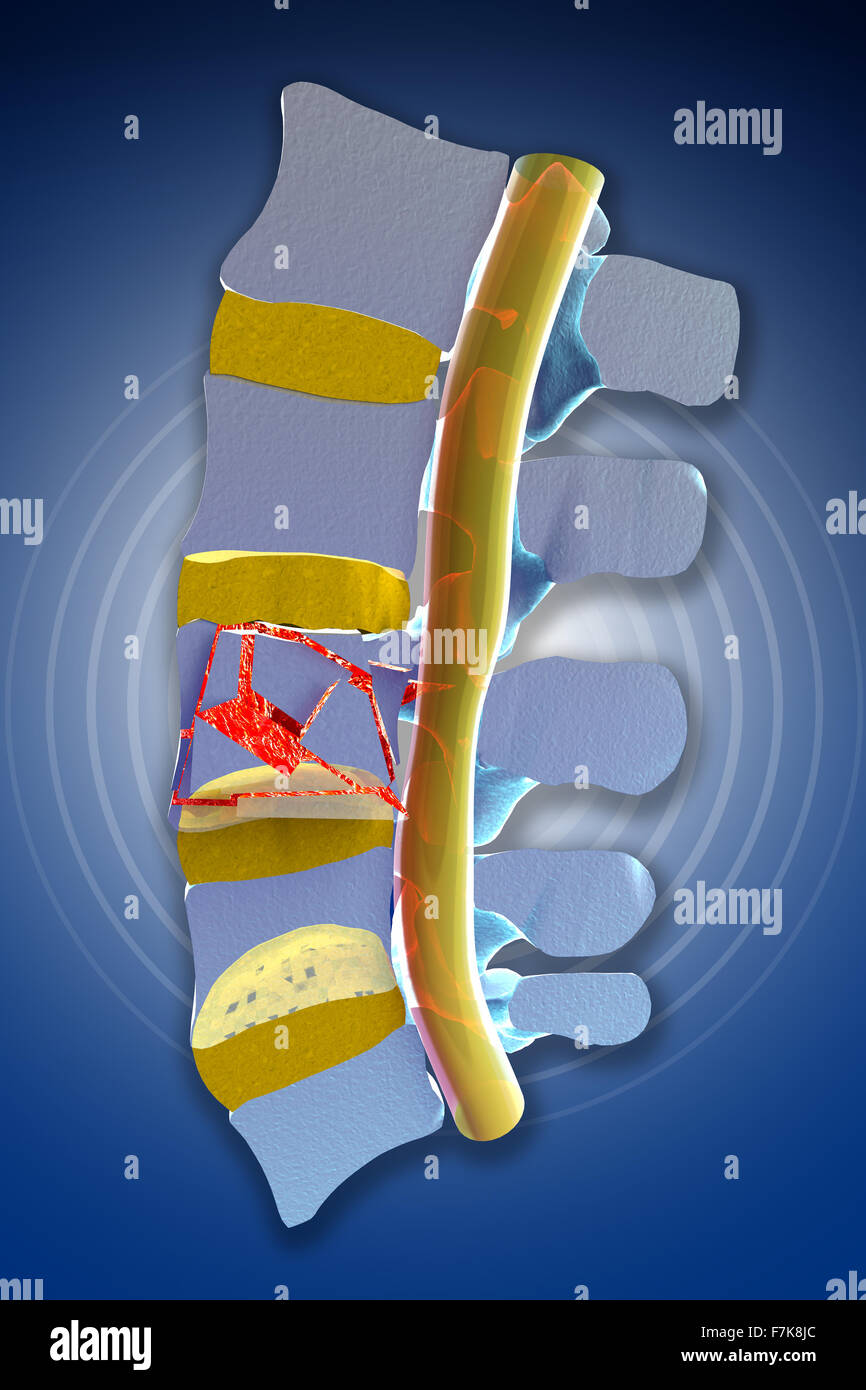 Fracture In Your Spine at Jasper Saranealis blog Fracture In Your Spine at Jasper Saranealis blog