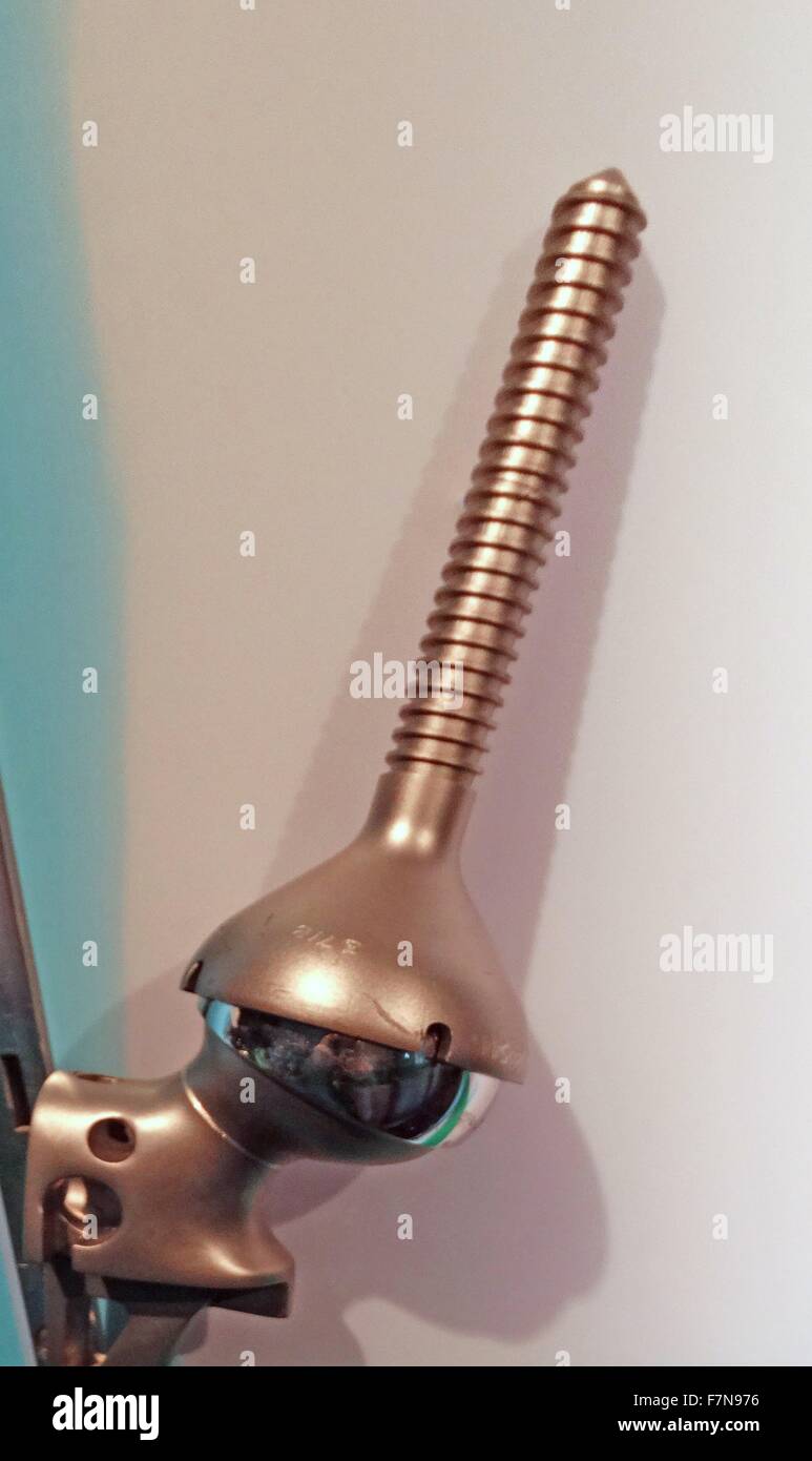 Ring' metal hip-replacement. Dated 2014 Stock Photo - Alamy