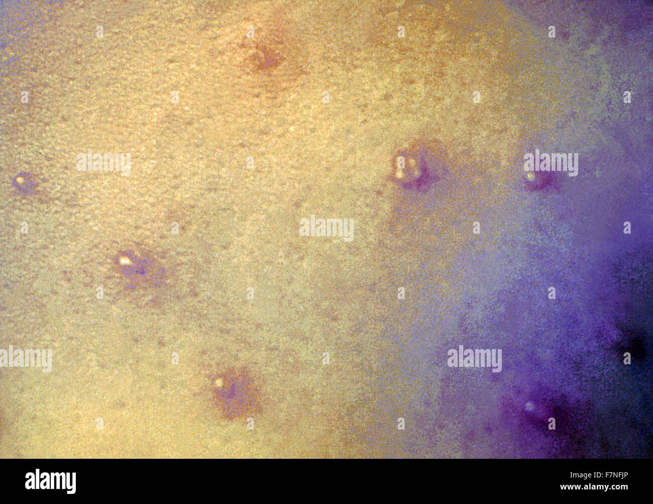 A close-up of a maculopapular rash, diagnosed as chickenpox lesions ...