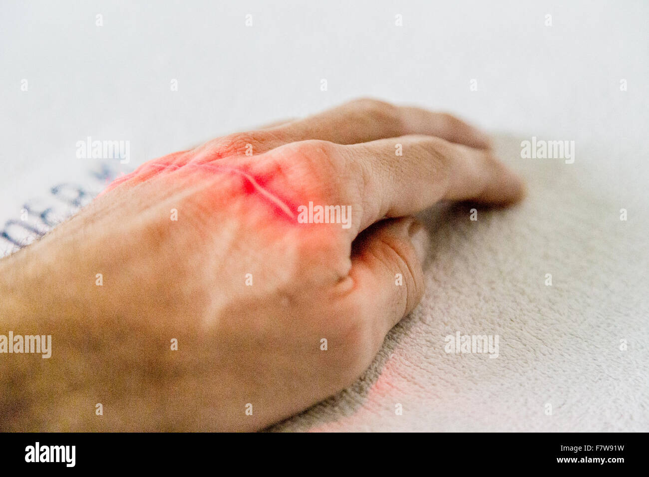 physiotherapy treatment with laser on caucasian hand Stock Photo - Alamy