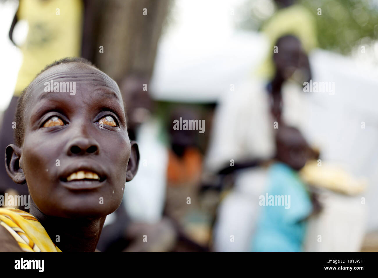 A women dealing with malnutrition is seen with poor eye sight in an ...