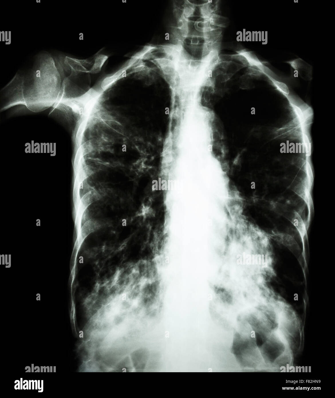 Chest Xray In A Patient With Disseminated Tb Showing The