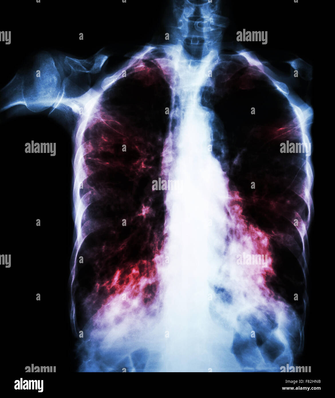 Pulmonary Tuberculosis ( film chest x-ray : interstitial infiltrate ...