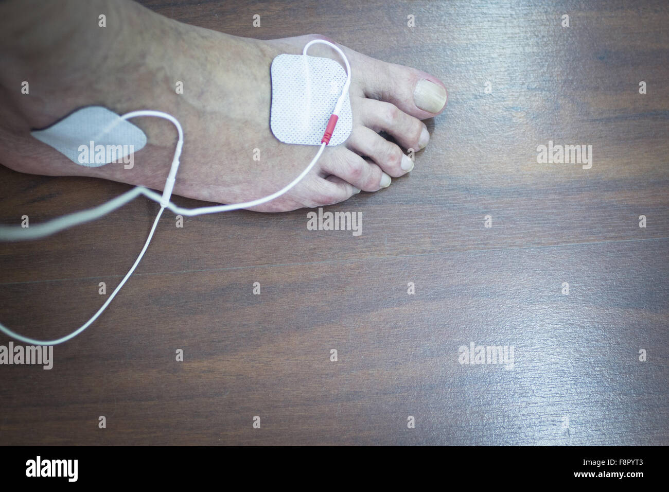 Patient foot, leg and ankle in electro physiotherapy electrical impulse ...