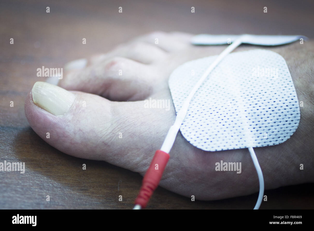 Patient foot, leg and ankle in electro physiotherapy electrical impulse ...