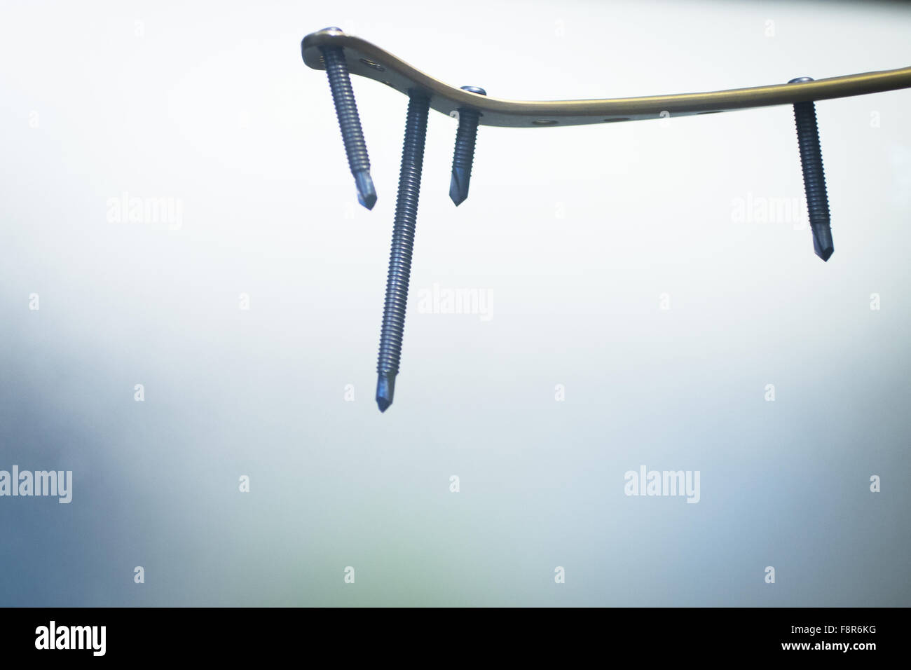 Traumatology and orthopedic surgery implant titanium plate and screws ...