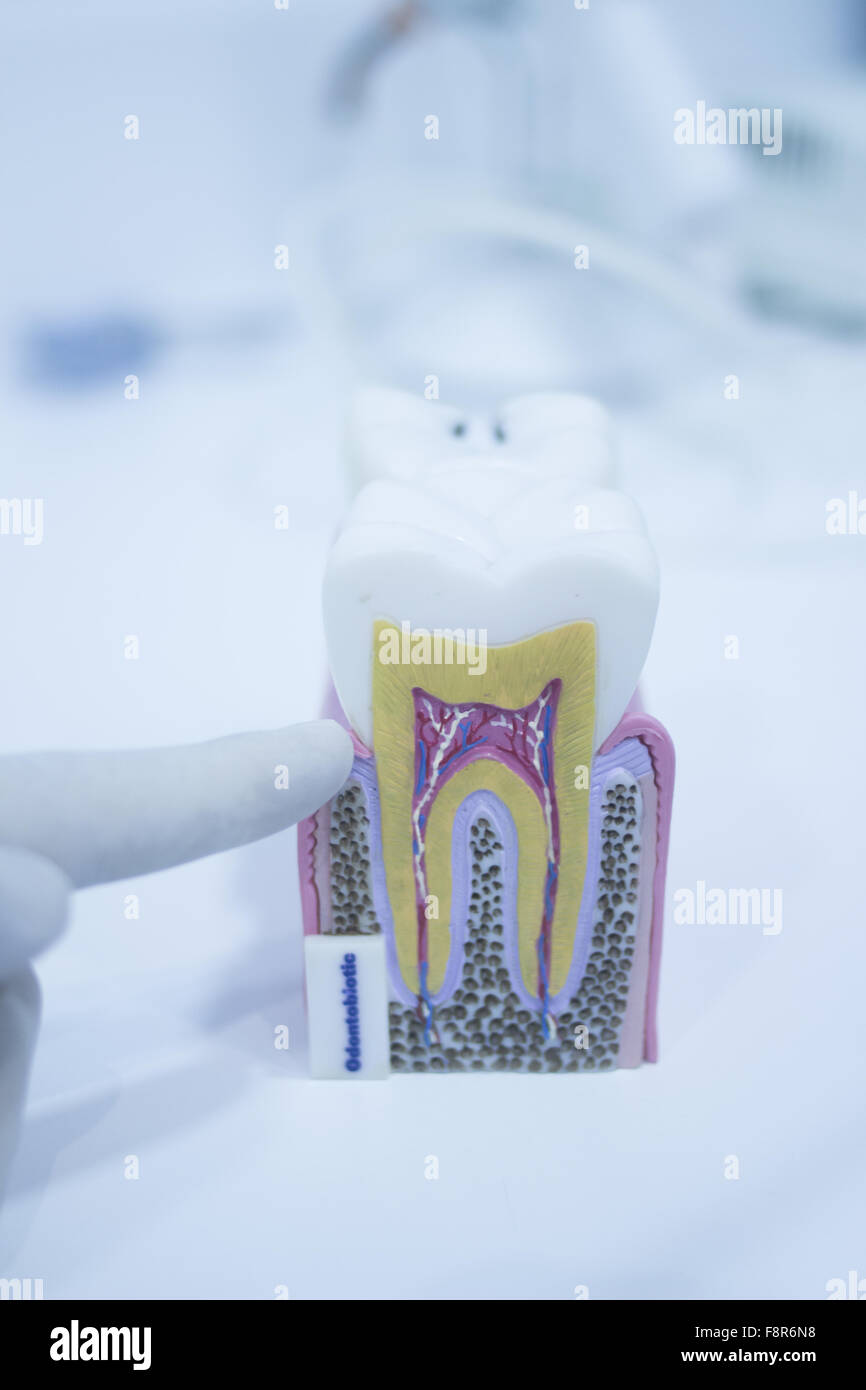 Dental tooth model cast showing decay causing pain and toothache ...