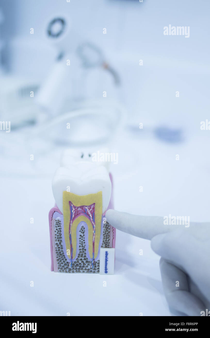 Dental tooth model cast showing decay causing pain and toothache ...