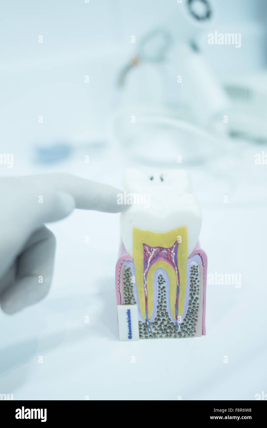 Dental tooth model cast showing decay causing pain and toothache ...