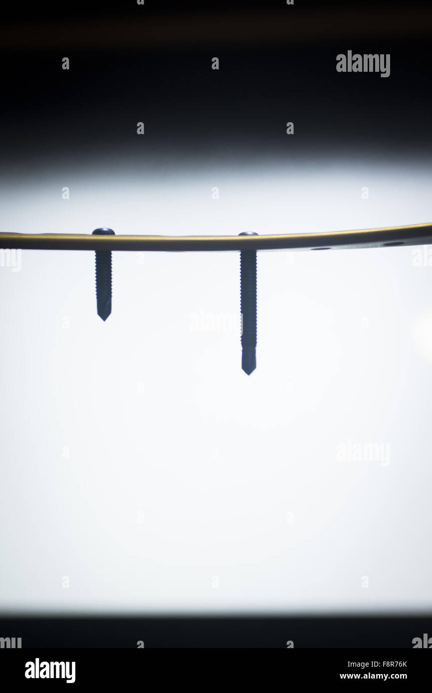 Traumatology and orthopedic surgery implant titanium plate and screws ...