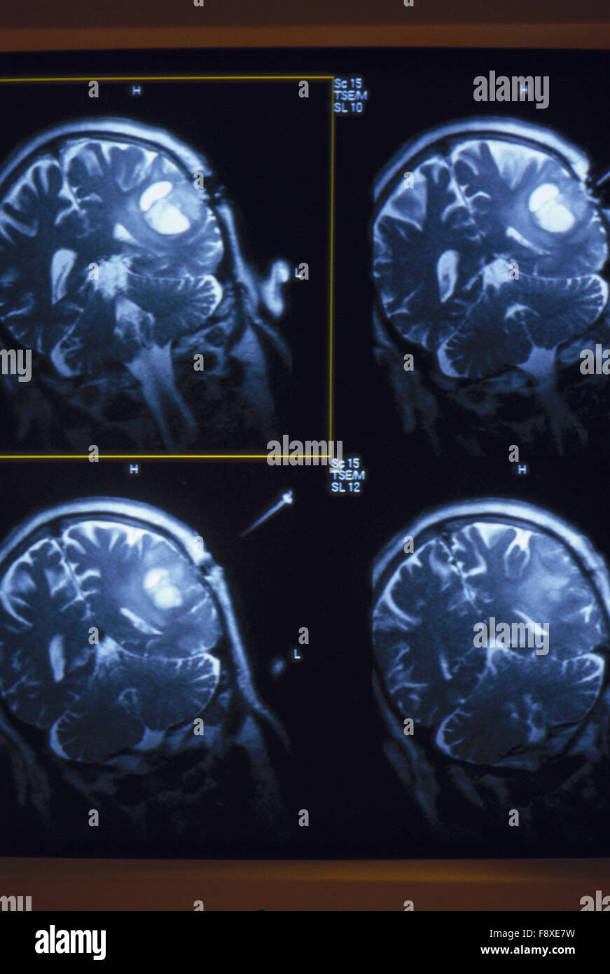 Hospital brain scans hi-res stock photography and images - Alamy
