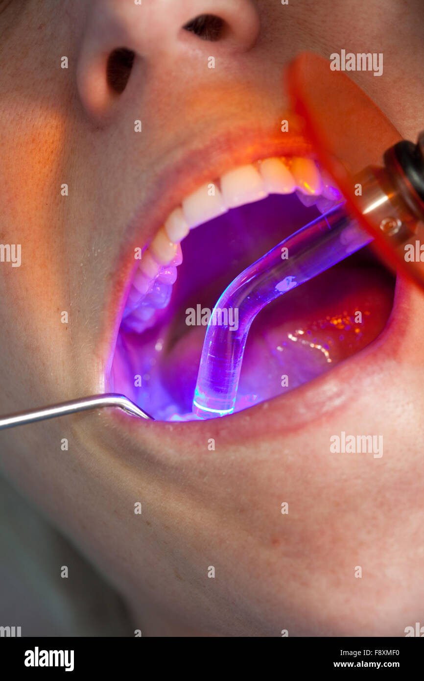 Drying of the dental filling Stock Photo - Alamy
