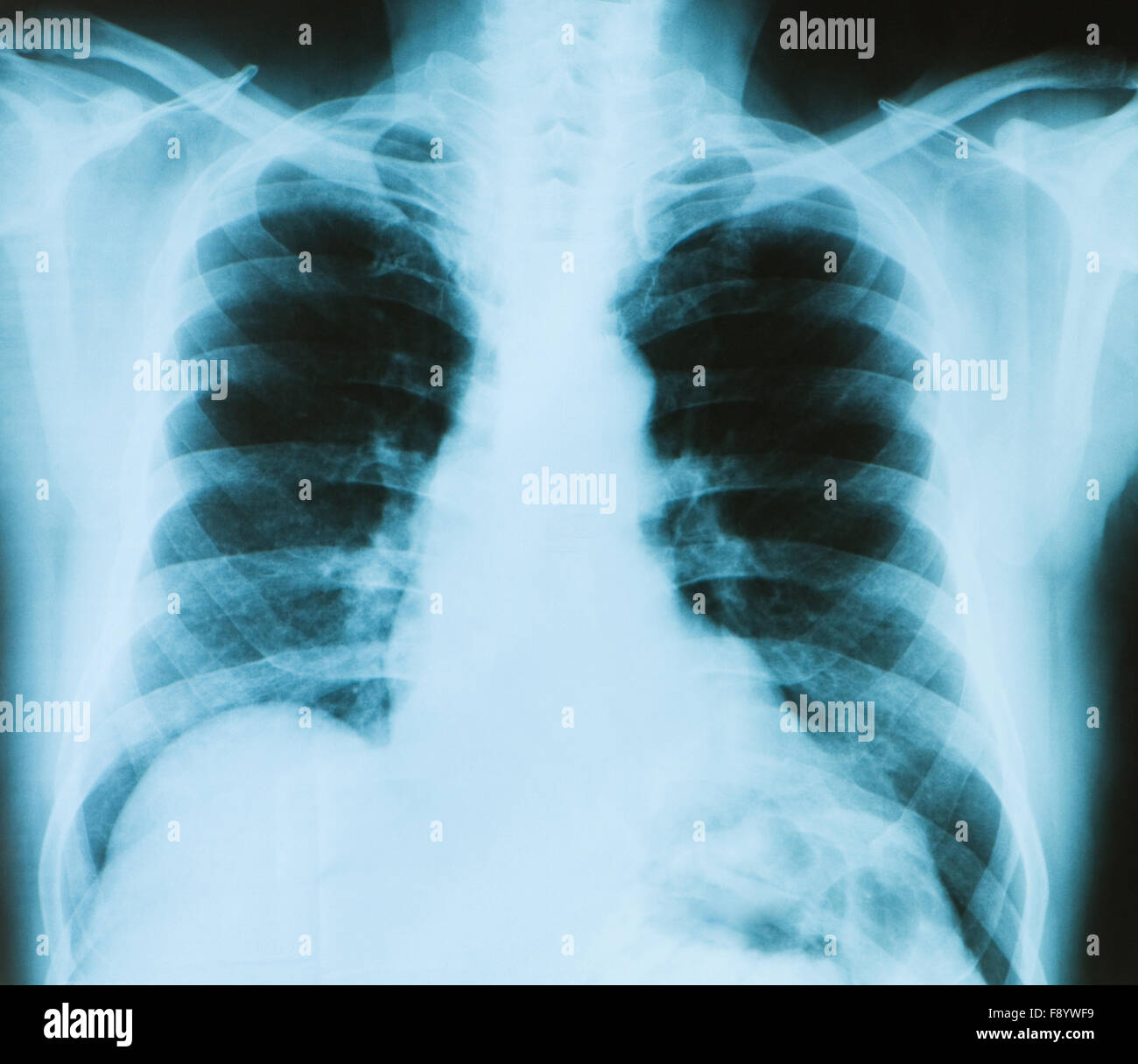 X-ray image of chest bones of adult Stock Photo - Alamy