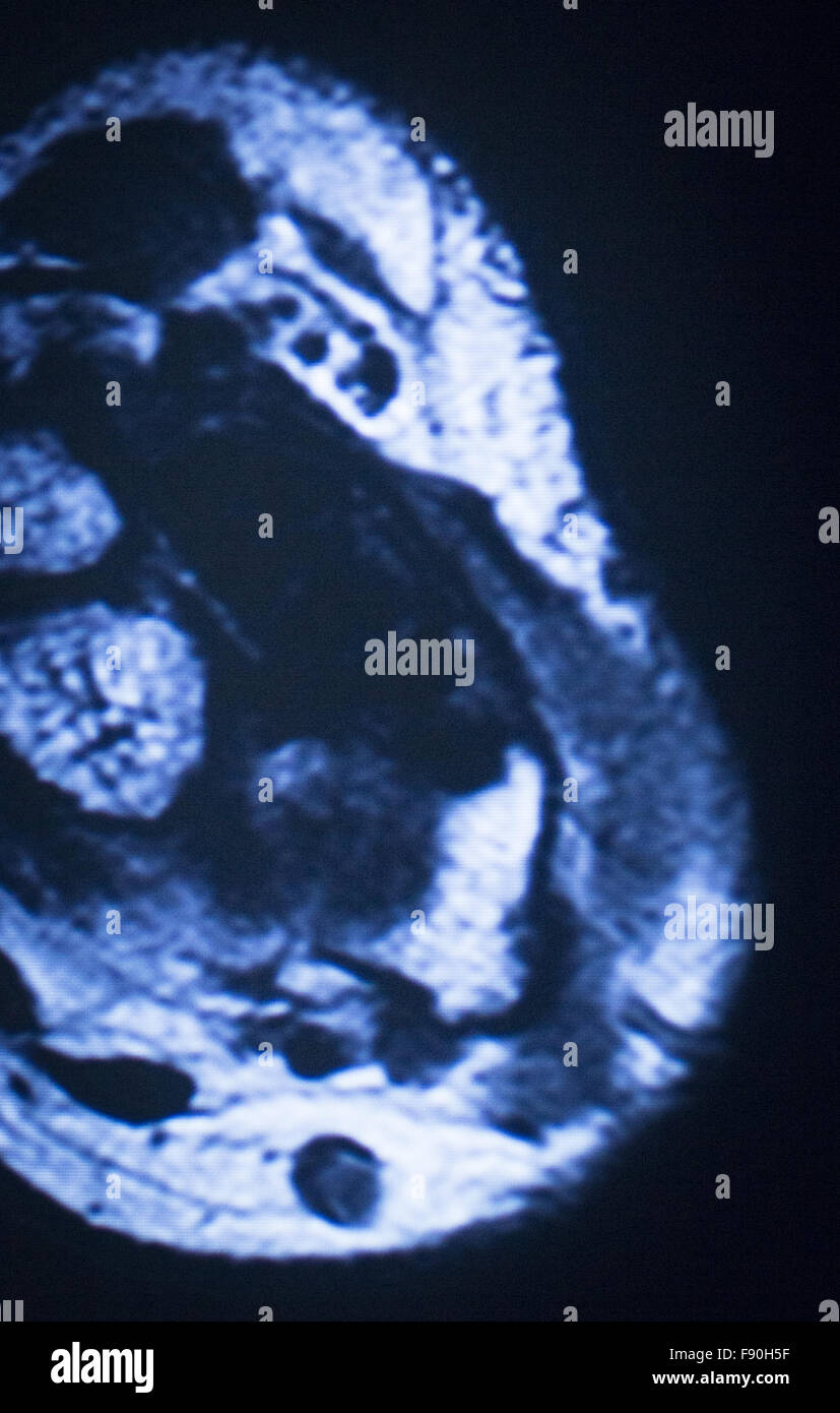 MRI magnetic resonance imaging medical scan test results of foot and ...