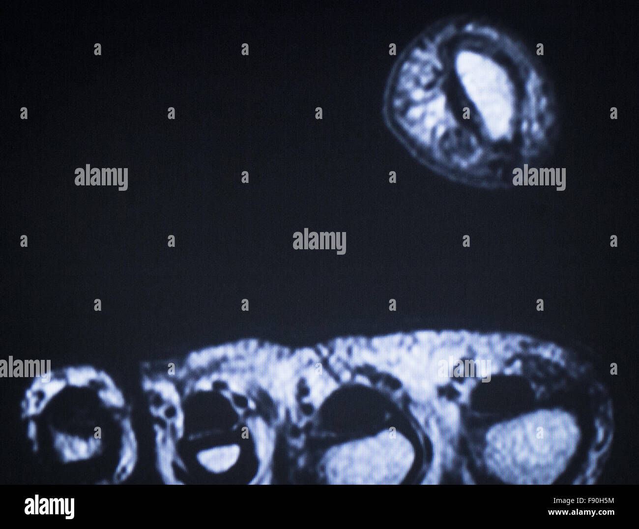 MRI magnetic resonance imaging medical scan test results of foot and ...