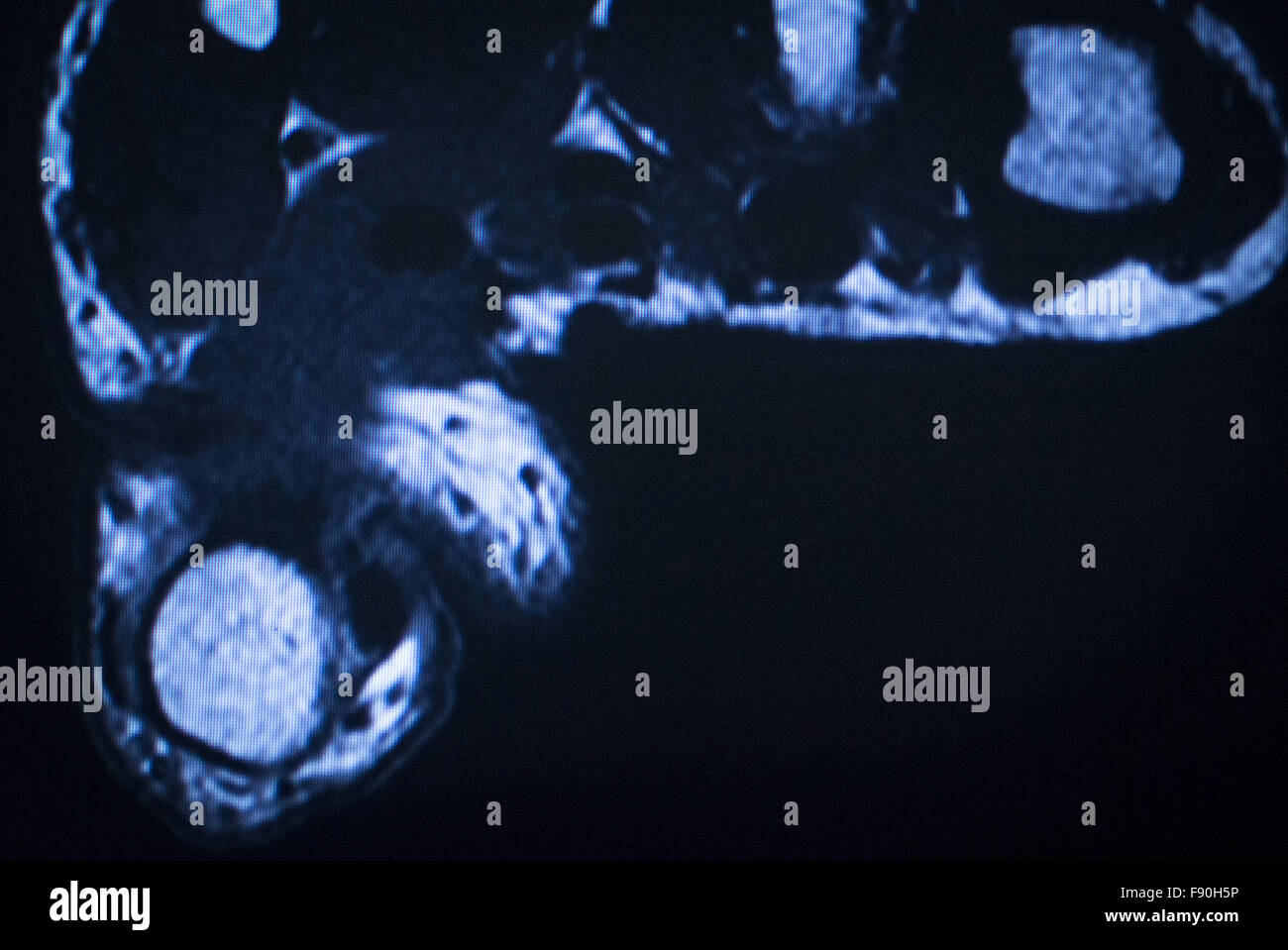 MRI magnetic resonance imaging medical scan test results of foot and ...